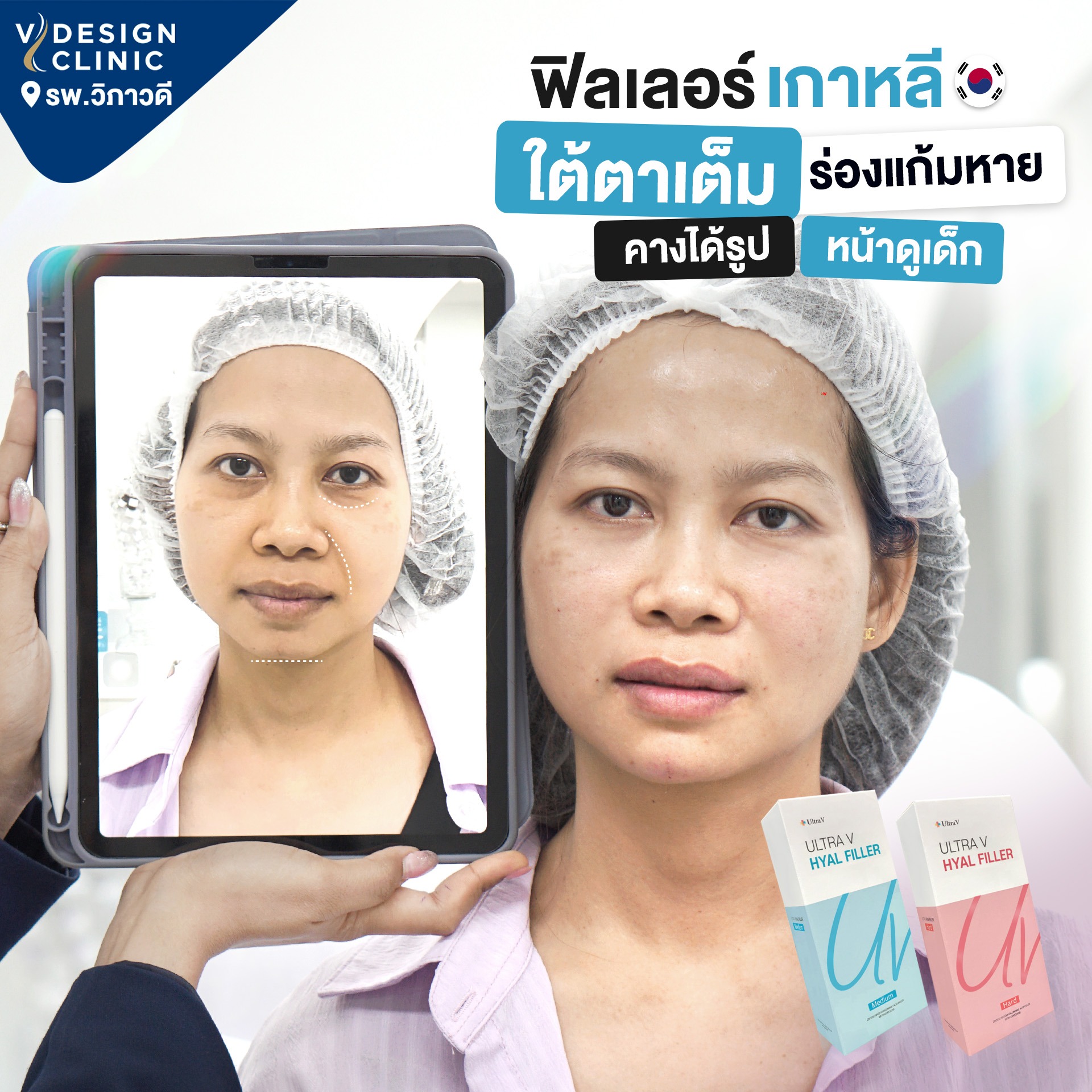 Ultra V Hyal Filler ฟิลเลอร์ทางเลือกใหม่ ปลอดภัย ได้มาตรฐาน